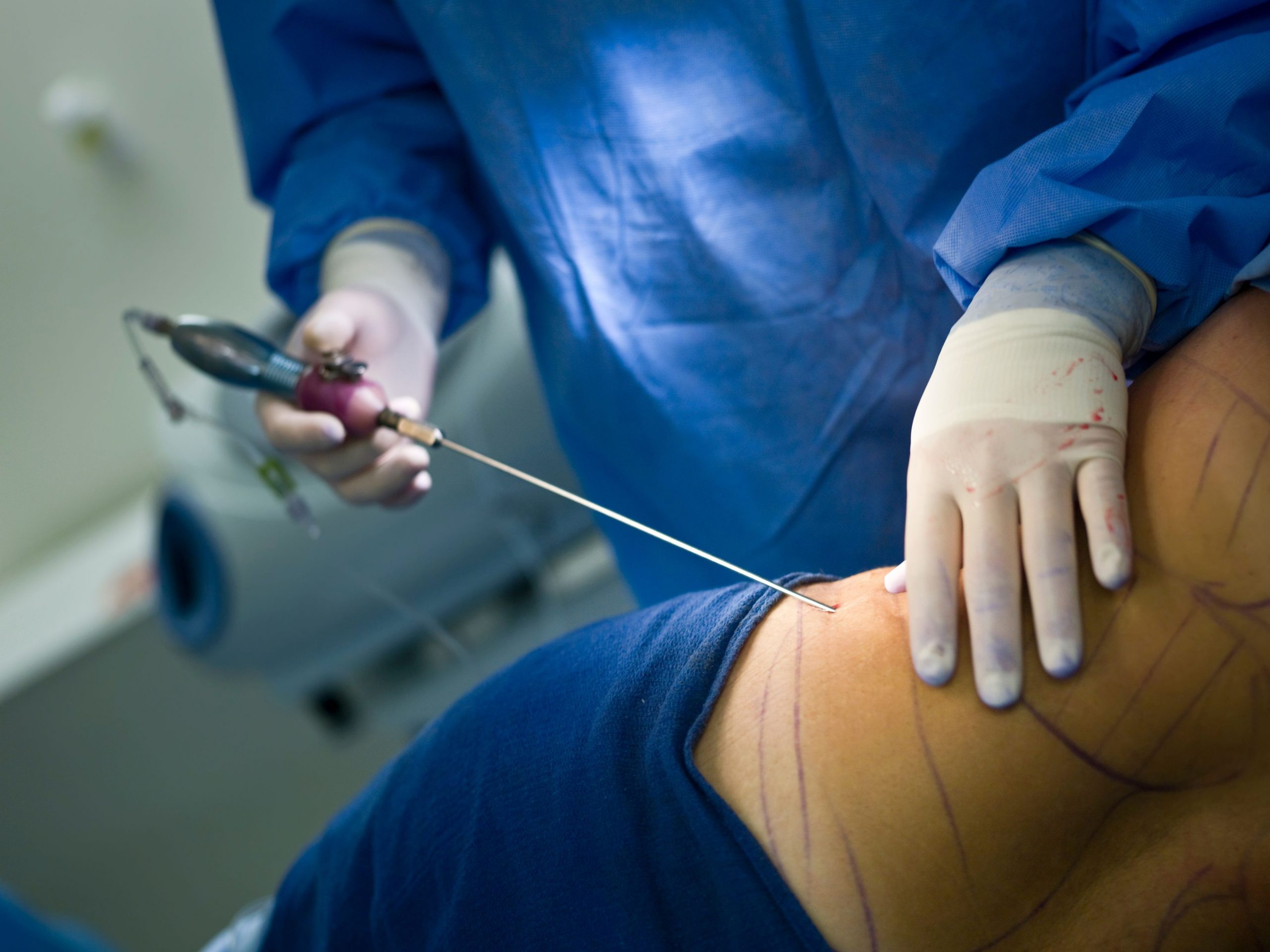 Ayaq liposaksiyasının fəsadları